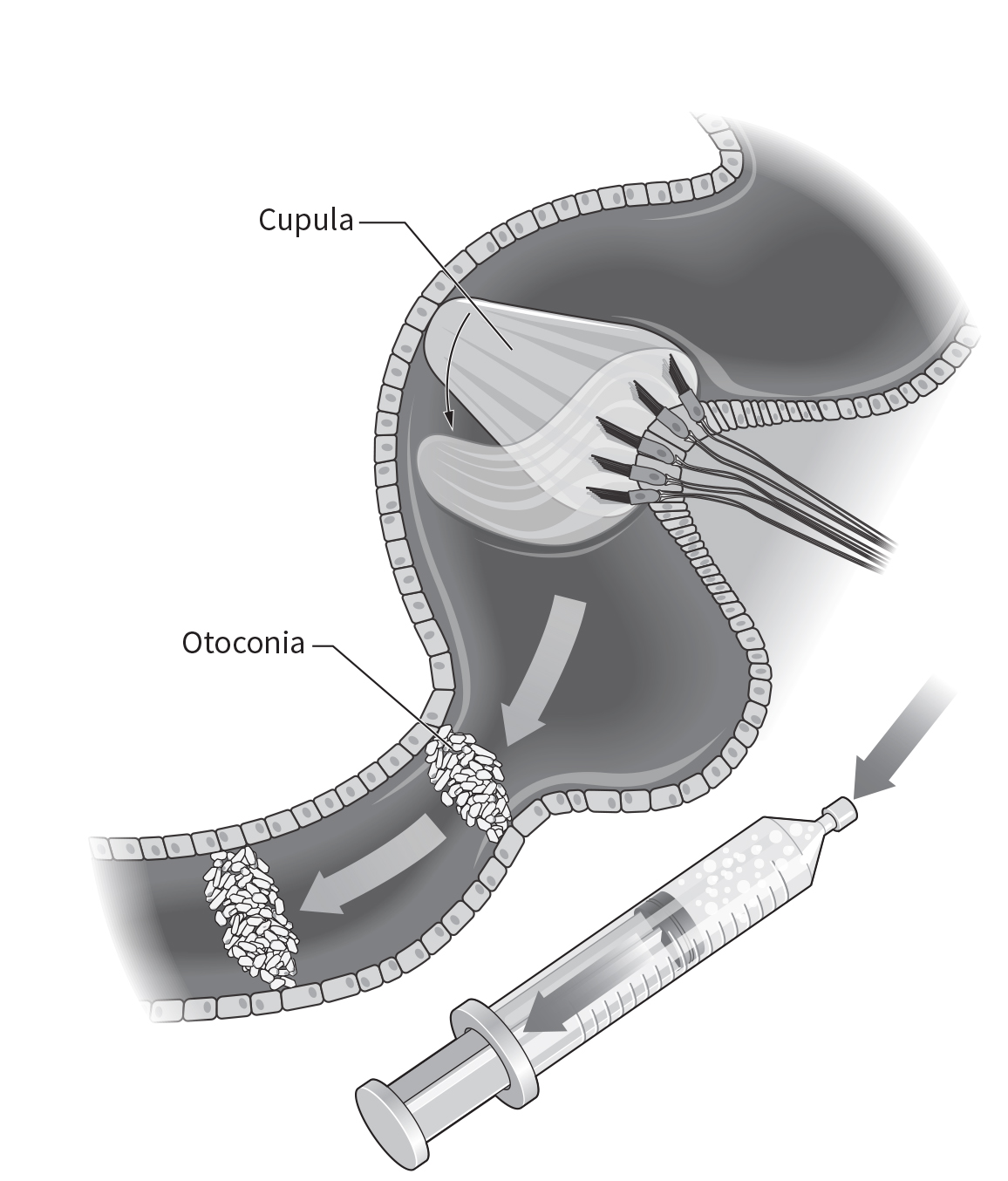 Ask the Doctor: BPPV – Ending Vertigo Today